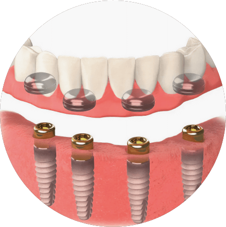 Advanced Locator Fixed Denture System - STOMADENT
