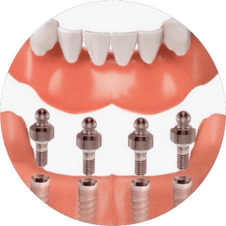 Snap-On Dentures | Stomadent Dental Lab