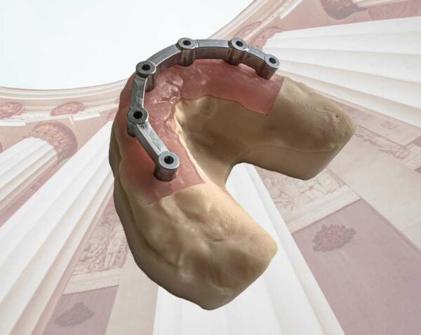 Milled Fixed Titanium Bars - STOMADENT