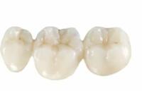 Comparing Types of Dental Impression Materials - STOMADENT