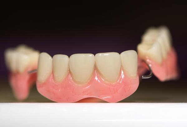 Partial Denture Clasp Types | Stomadent Dental Lab