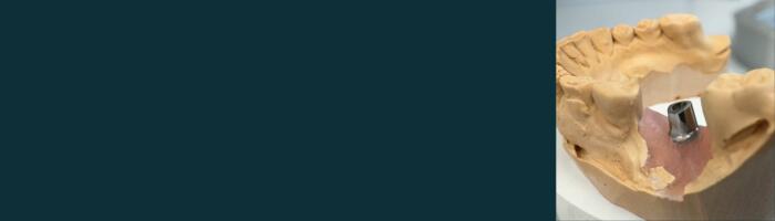 Custom Titanium Abutments - STOMADENT