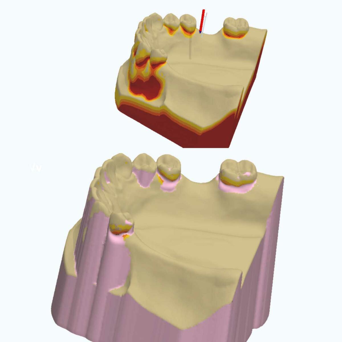 Acrylic Partials - STOMADENT