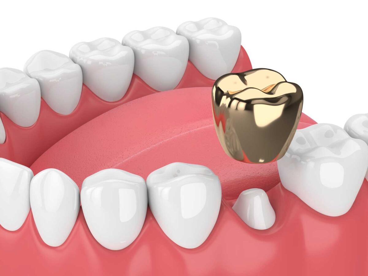 Full Metal Crown