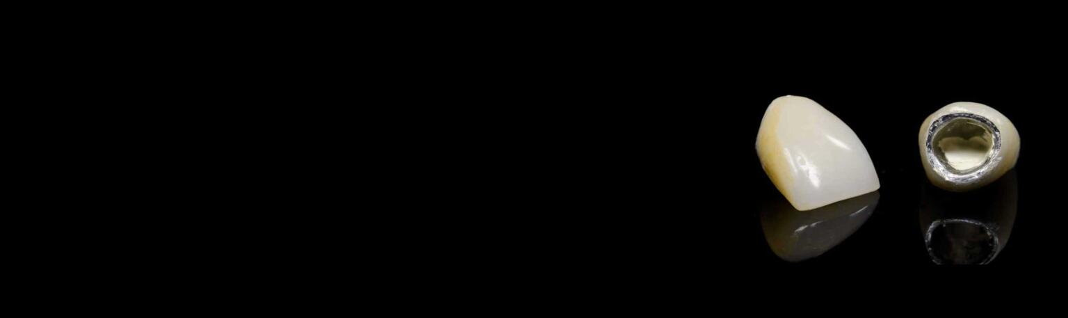 PFM Crowns - Stodament Dental Laboratory